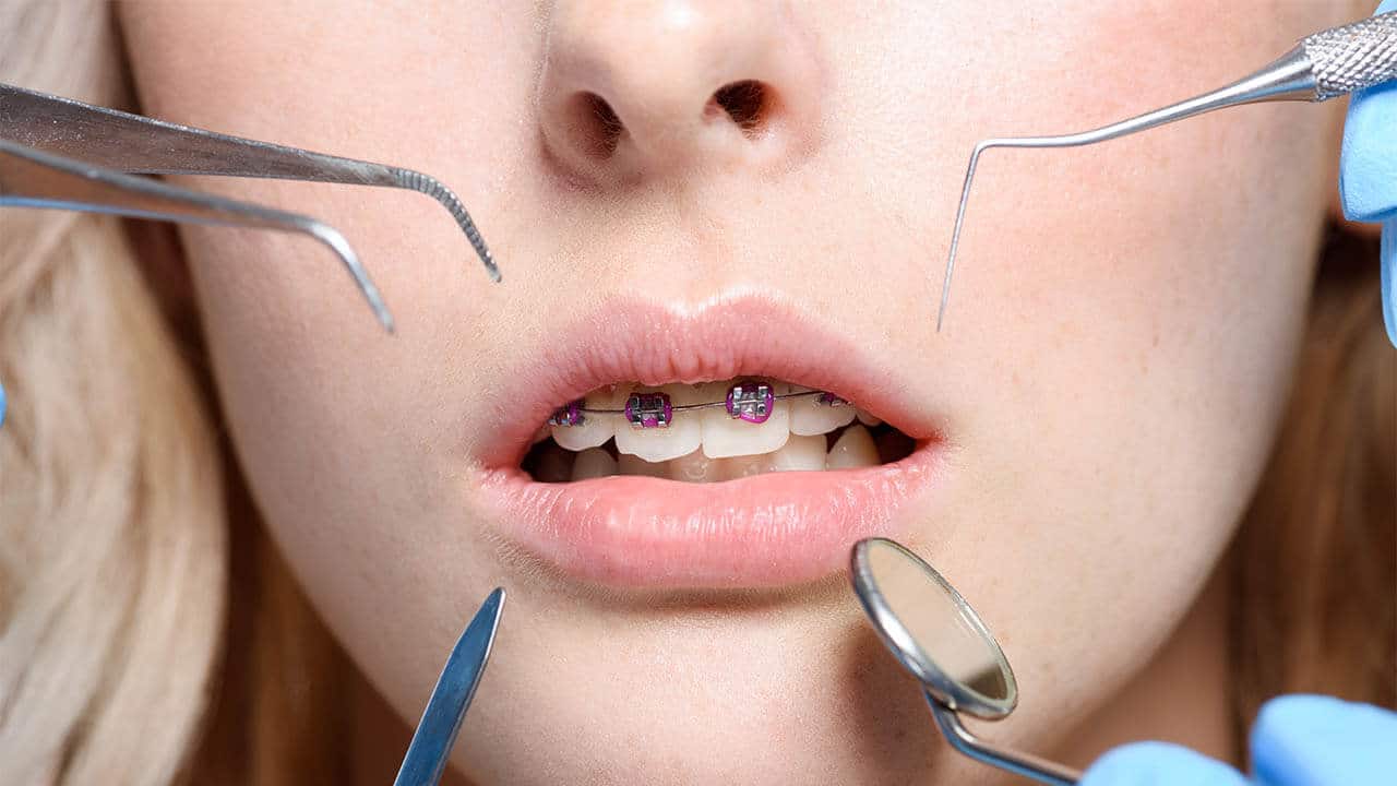 FAMILY BRACES • Can't you just fix my front teeth?