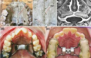 Everything You Need to Know About Palatal Expanders in Orthodontics - Family Braces