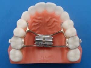 Everything You Need to Know About Palatal Expanders in Orthodontics ...