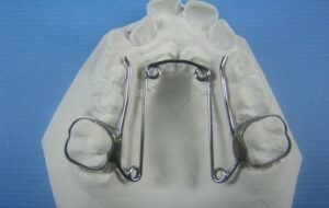 Everything You Need to Know About Palatal Expanders in Orthodontics ...