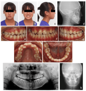 Everything You Need to Know About Palatal Expanders in Orthodontics ...