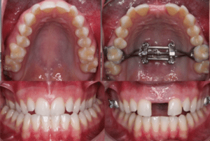 Everything You Need to Know About Palatal Expanders in Orthodontics ...